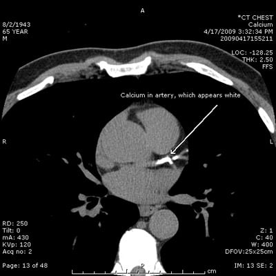 Iowa Radiology Blog | CT cardiac calcium scoring