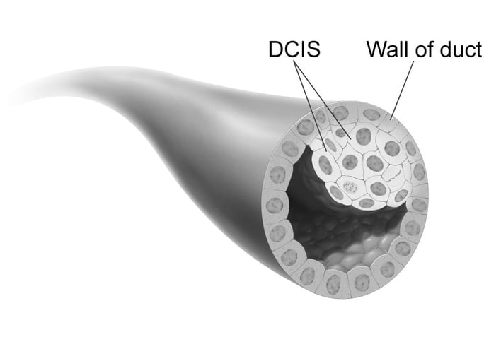 What Is DCIS, and How Is It Treated?